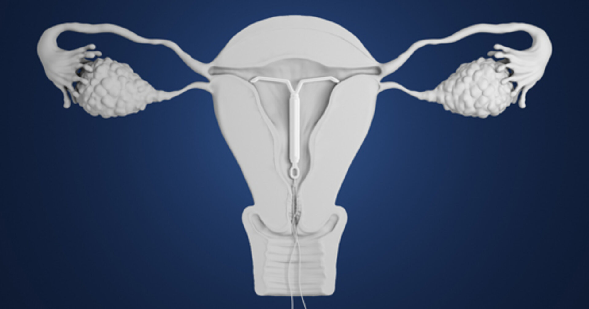 How IUDs work, and what to expect during and after insertion ...